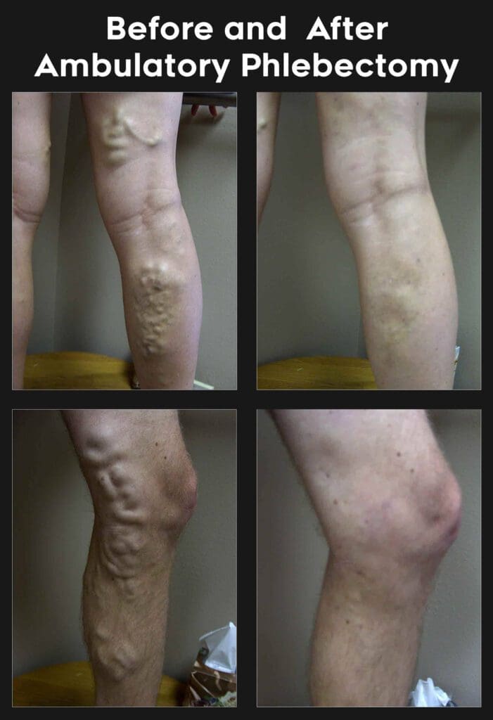 Varicose Vein Surgery Orlando | Ambulatory Phlebectomy Orlando
